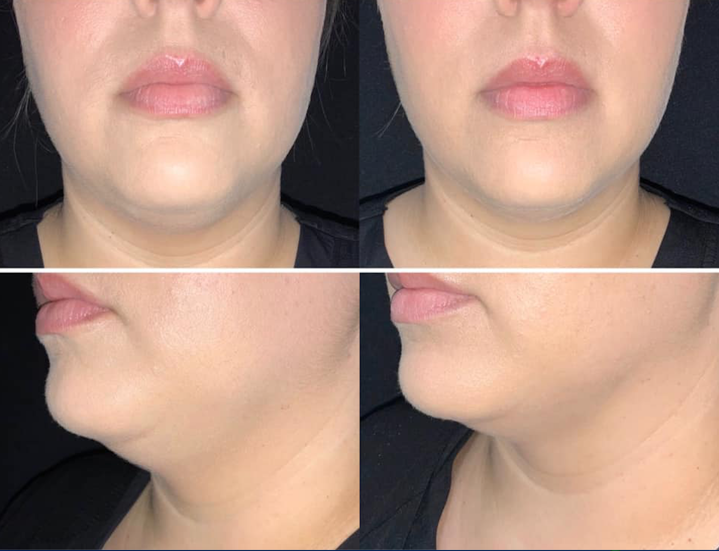 Kybella Before and After | PureLife Medi-Spa Wellness and Skincare